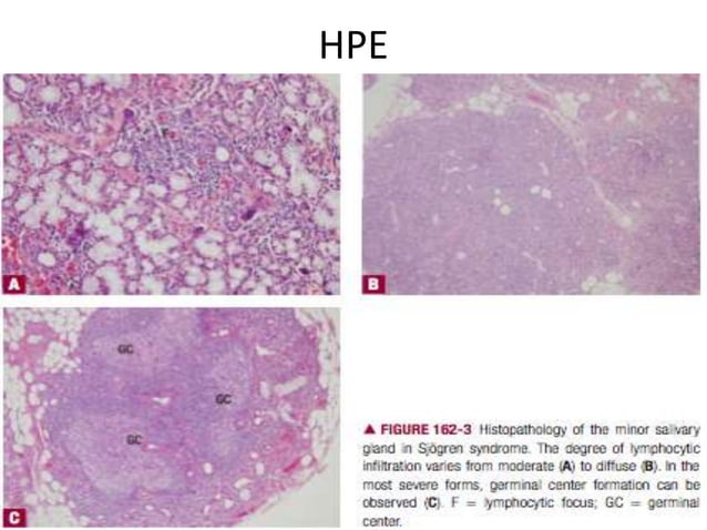 Sjogren syndrome by aseem | PPT
