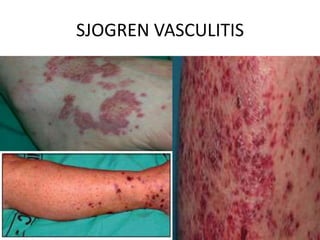 Sjogren syndrome by aseem | PPTX