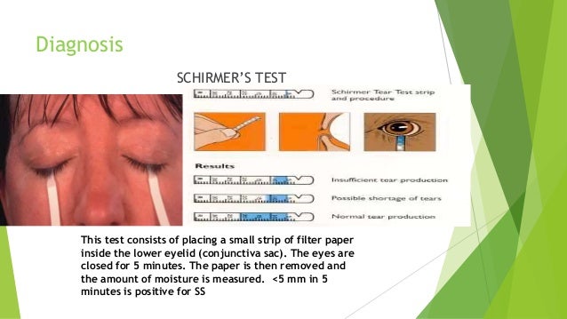 Sjogren syndrome, halitosis & treatment of osf
