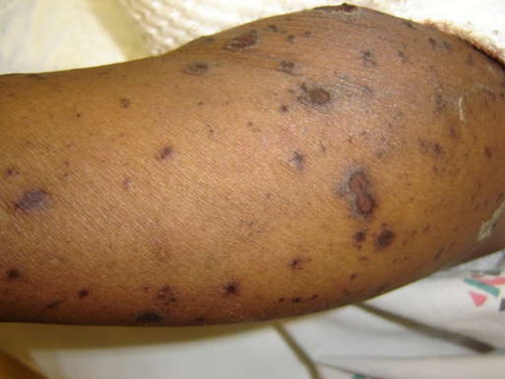 Stevens-Johnson Syndrome