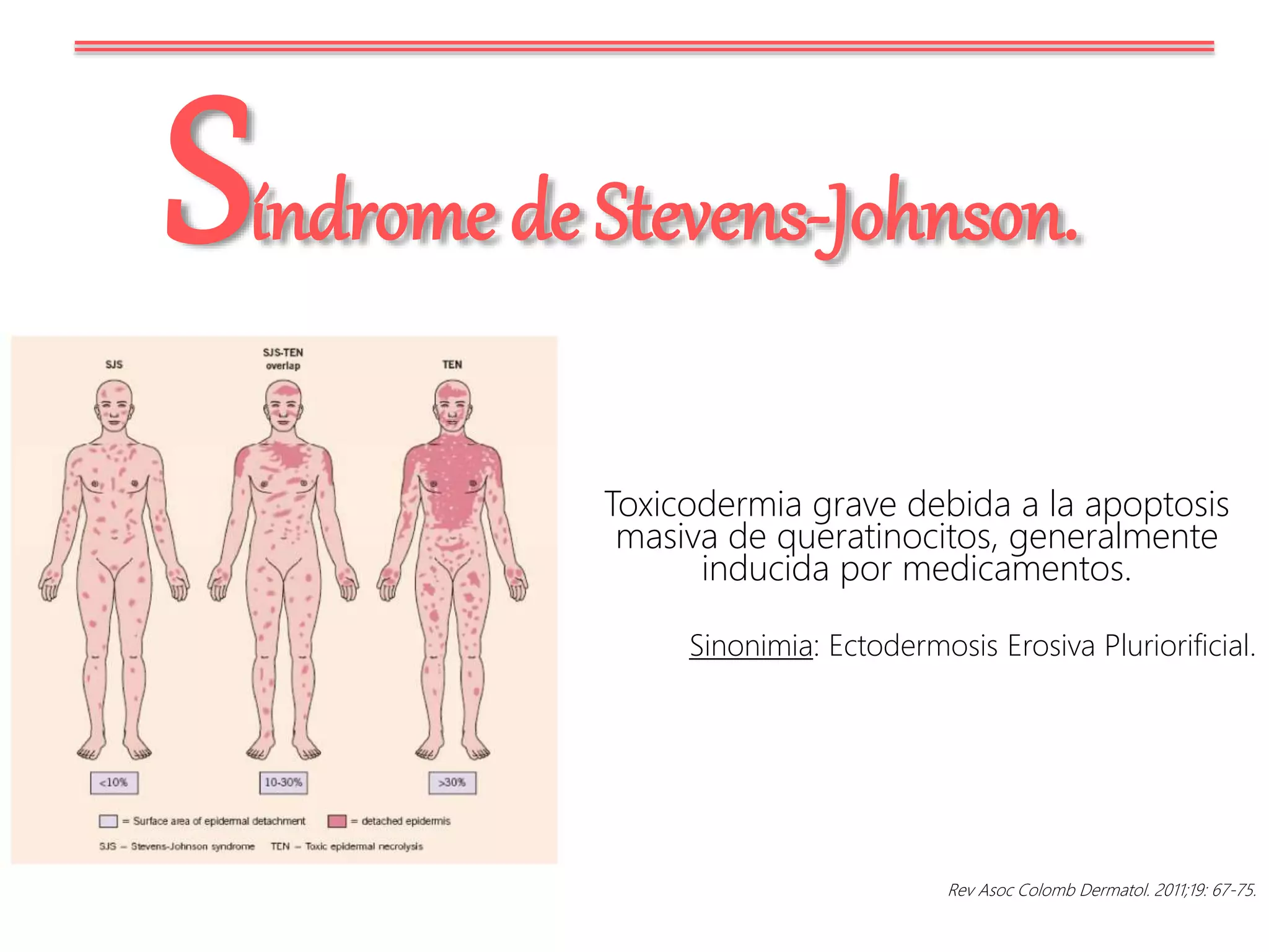 Síndrome de Stevens-Johnson. | PPTX