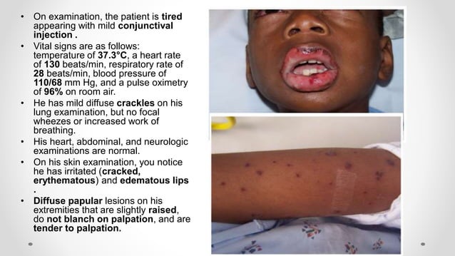 steven johnson syndrome | PPTX