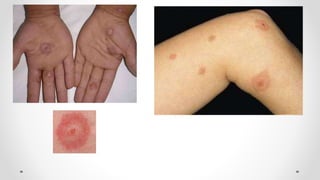 steven johnson syndrome | PPTX