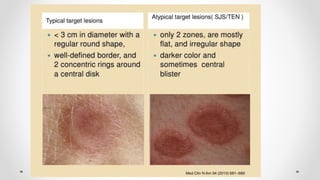 steven johnson syndrome | PPTX