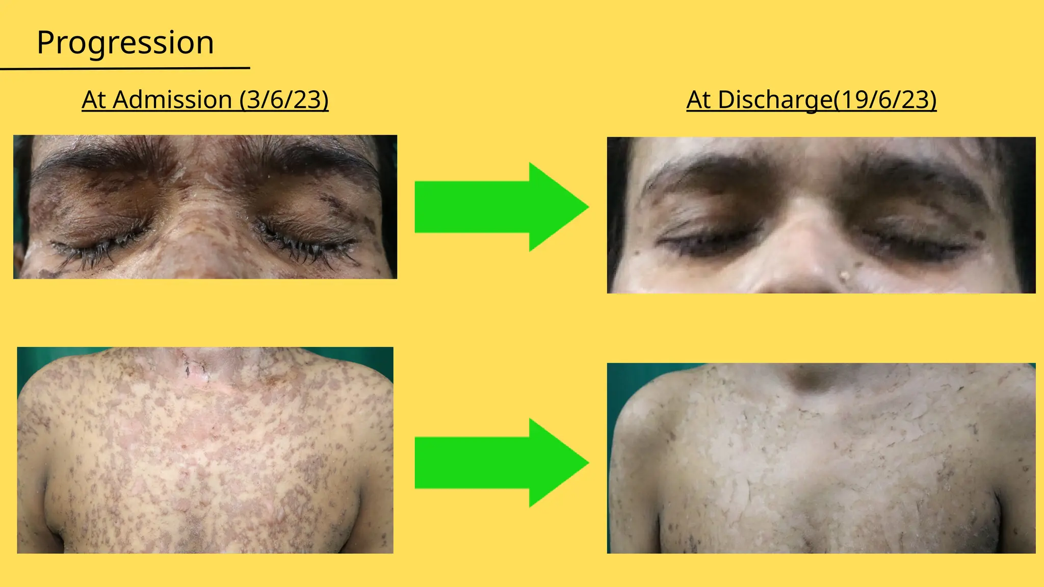 Fragile Skin, Resilient Spirit: A Case Report on Stevens–Johnson ...
