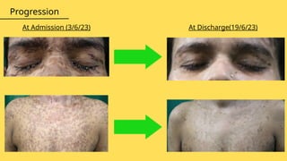 Fragile Skin, Resilient Spirit: A Case Report on Stevens–Johnson ...
