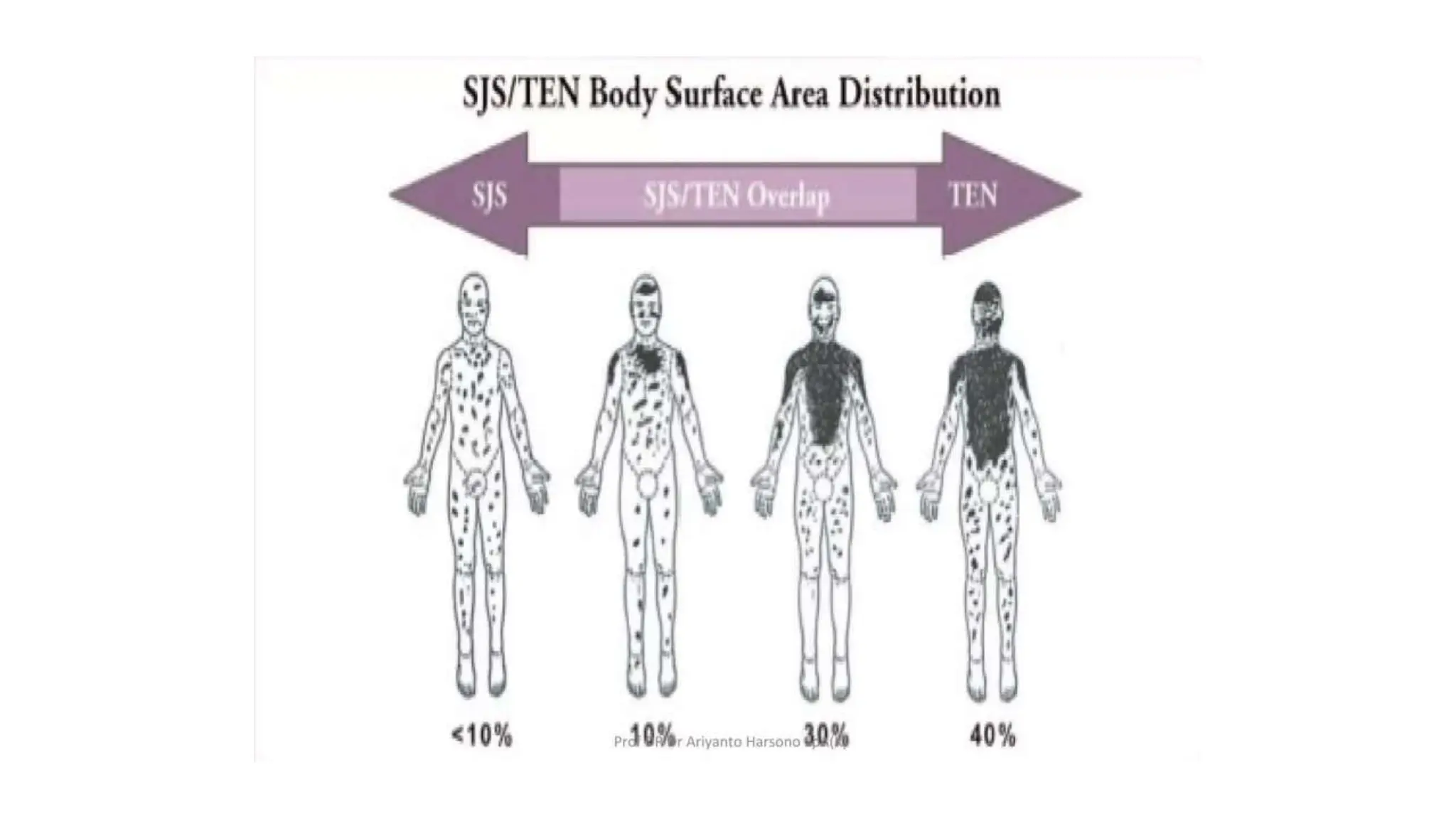 Steven Johnson Syndrome (SJS) and Toxic Epidermal Necrolysis (TEN) | PPTX