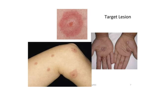 Steven Johnson Syndrome (SJS) and Toxic Epidermal Necrolysis (TEN ...