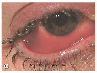 Sjs stevens johnson syndorme Eye Ophthalmology | PPT