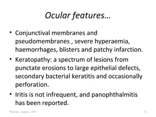 Sjs stevens johnson syndorme Eye Ophthalmology | PPT