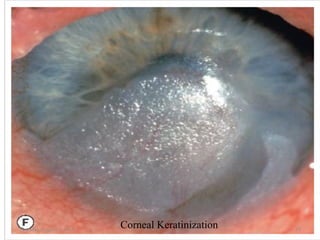 Sjs stevens johnson syndorme Eye Ophthalmology | PPT