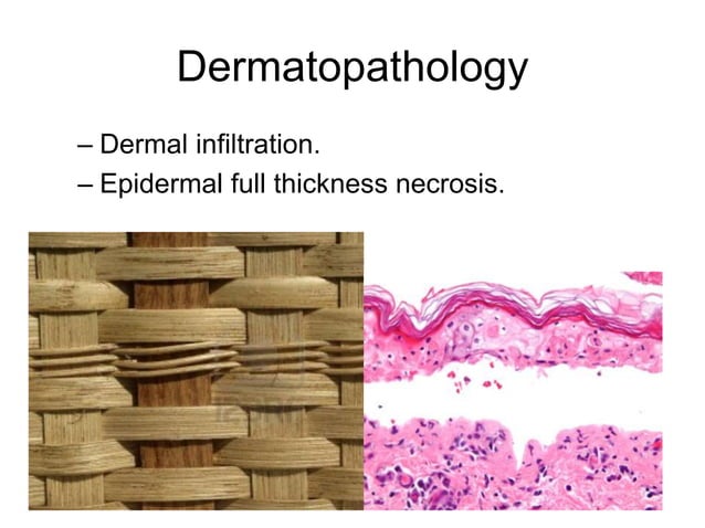 Stevens-Johnson syndrome/ Toxic epidermal necrolysis emergency ...
