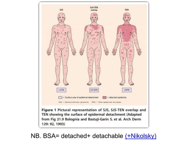 Stevens-Johnson syndrome/ Toxic epidermal necrolysis emergency ...