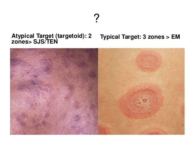 Stevens-Johnson syndrome/ Toxic epidermal necrolysis emergency guidel…