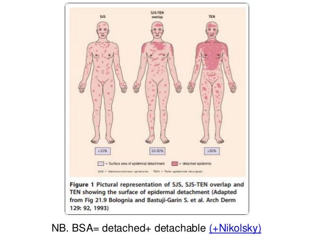 Stevens-Johnson syndrome/ Toxic epidermal necrolysis emergency guidel…