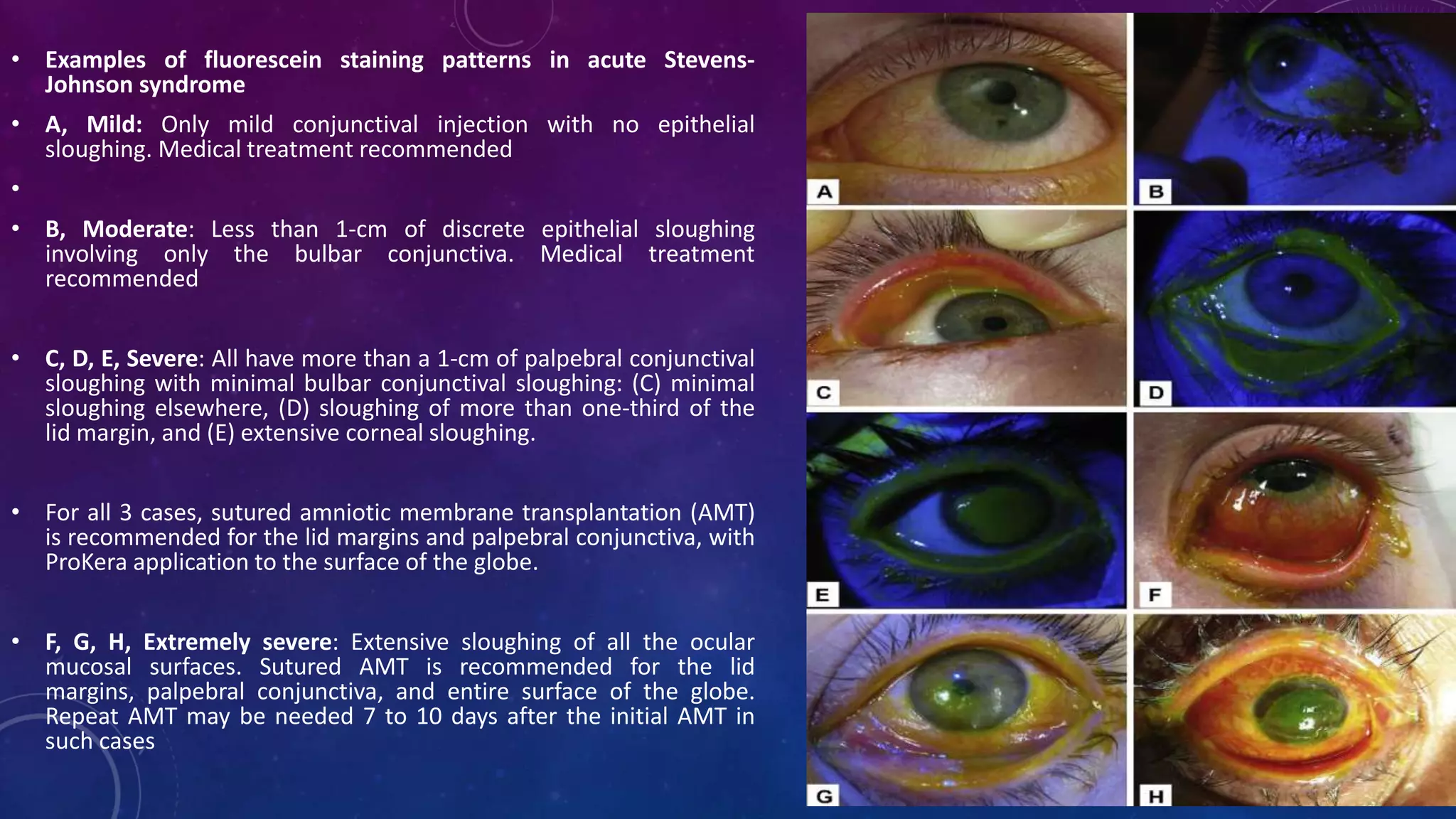 Ocular cicatricial pemphigoid, Stevens-Johnson Syndrome, Toxic ...