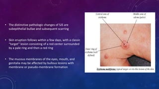 Ocular cicatricial pemphigoid, Stevens-Johnson Syndrome, Toxic ...