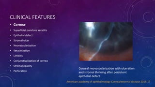 Ocular cicatricial pemphigoid, Stevens-Johnson Syndrome, Toxic ...