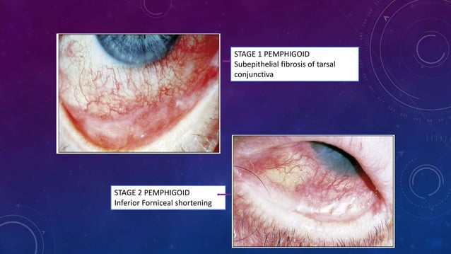 Ocular cicatricial pemphigoid, Stevens-Johnson Syndrome, Toxic ...
