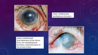 Ocular Pemphigoid