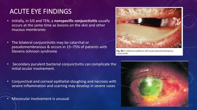 Ocular cicatricial pemphigoid, Stevens-Johnson Syndrome, Toxic ...