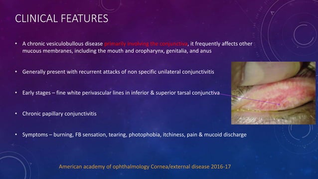 Ocular cicatricial pemphigoid, Stevens-Johnson Syndrome, Toxic ...