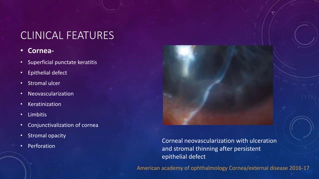Ocular cicatricial pemphigoid, Stevens-Johnson Syndrome, Toxic ...