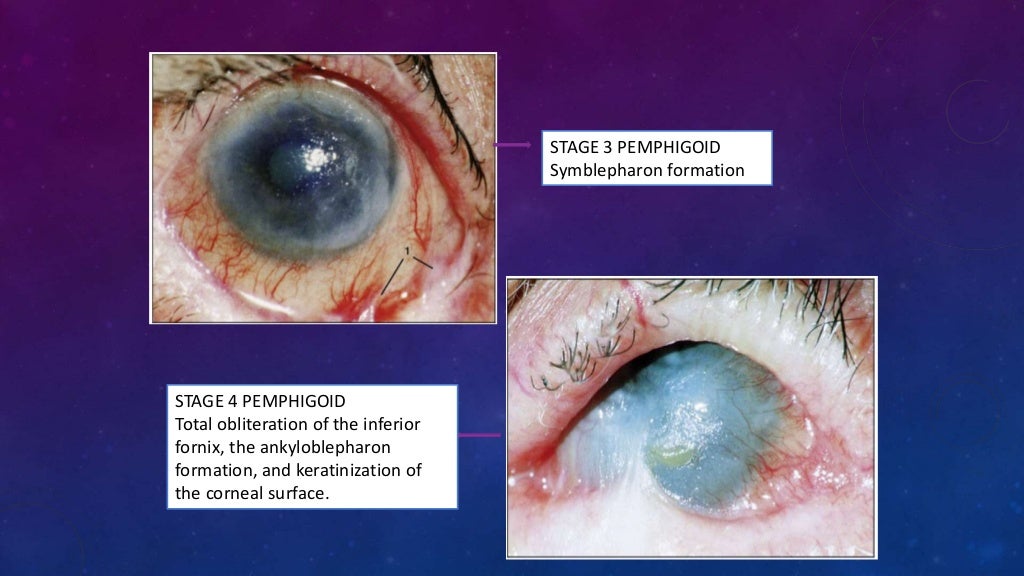 Ocular cicatricial pemphigoid, Stevens-Johnson Syndrome, Toxic Epider…