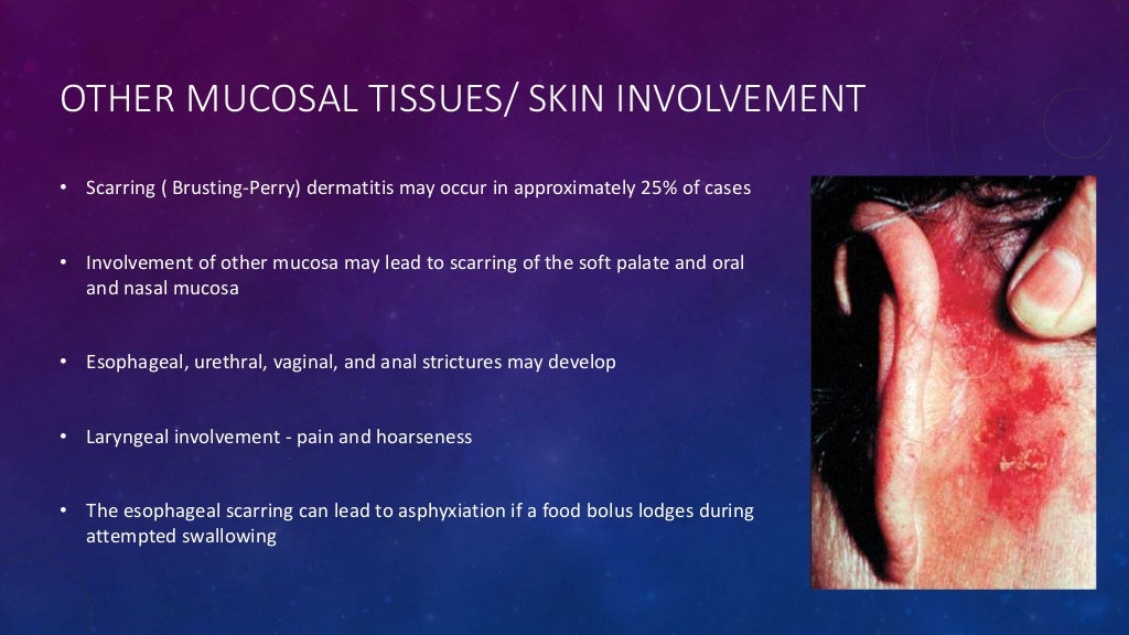 Ocular cicatricial pemphigoid, Stevens-Johnson Syndrome, Toxic Epider…