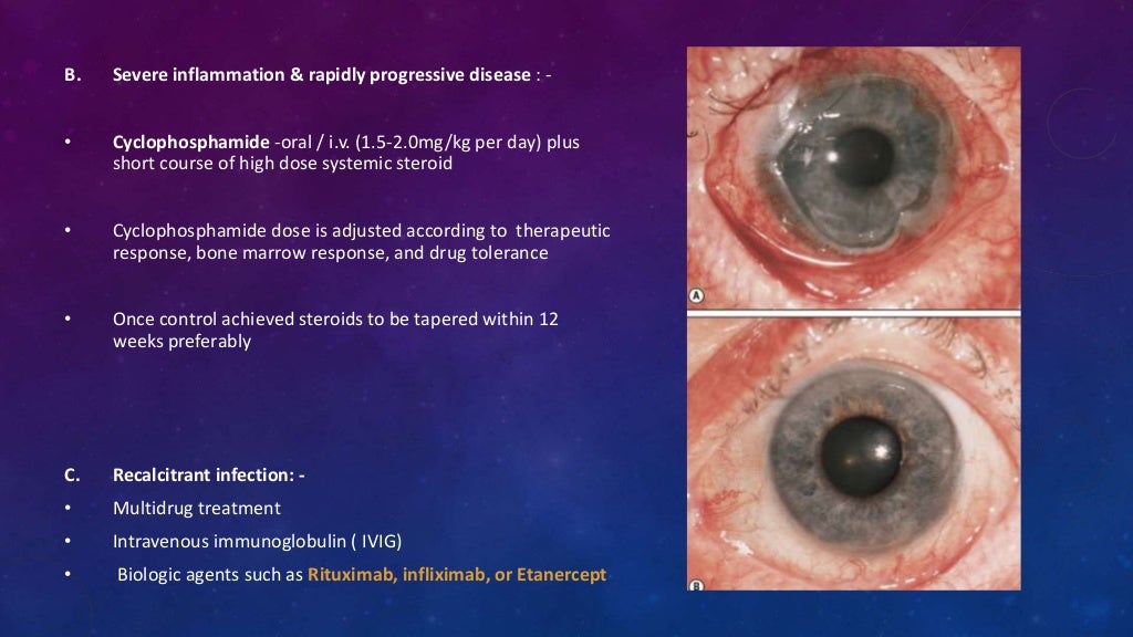 Ocular cicatricial pemphigoid, Stevens-Johnson Syndrome, Toxic Epider…