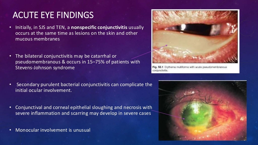 Ocular cicatricial pemphigoid, Stevens-Johnson Syndrome, Toxic Epider…