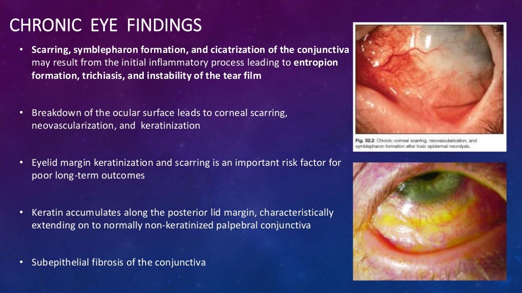 Ocular cicatricial pemphigoid, Stevens-Johnson Syndrome, Toxic Epider…