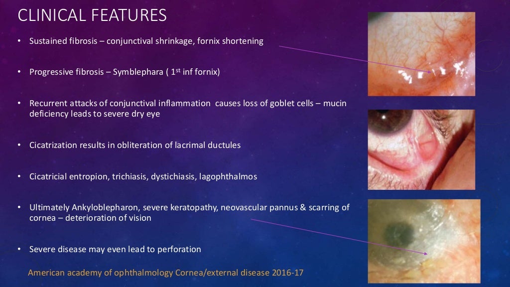 Ocular cicatricial pemphigoid, Stevens-Johnson Syndrome, Toxic Epider…
