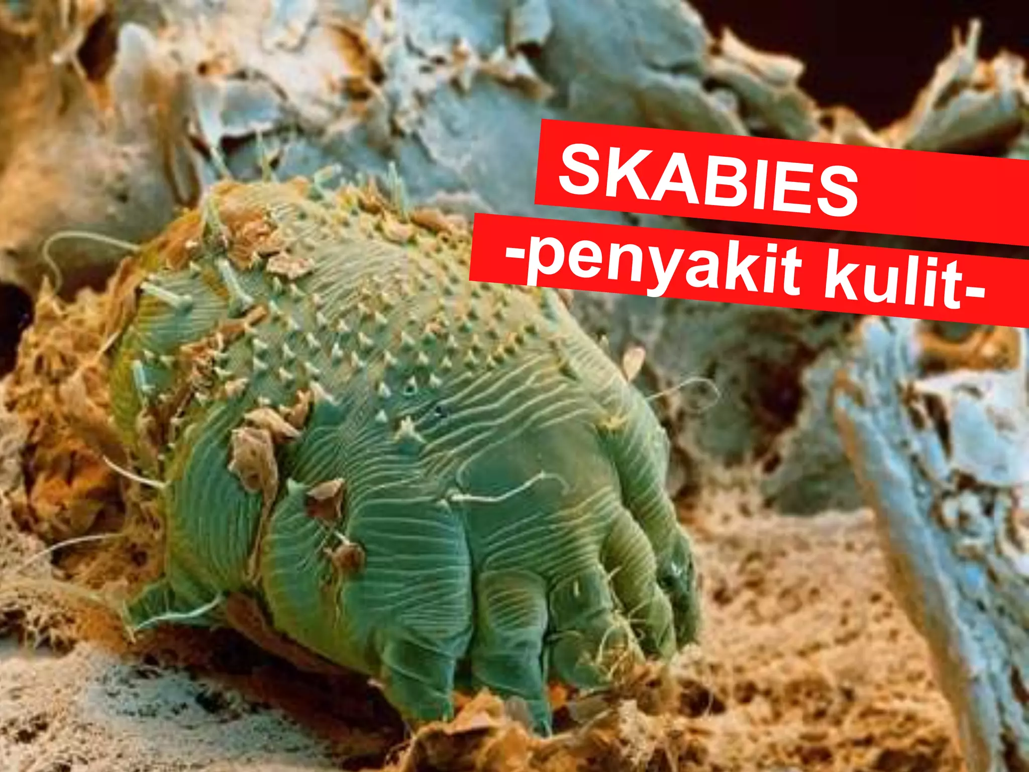 Skabies | PPTX