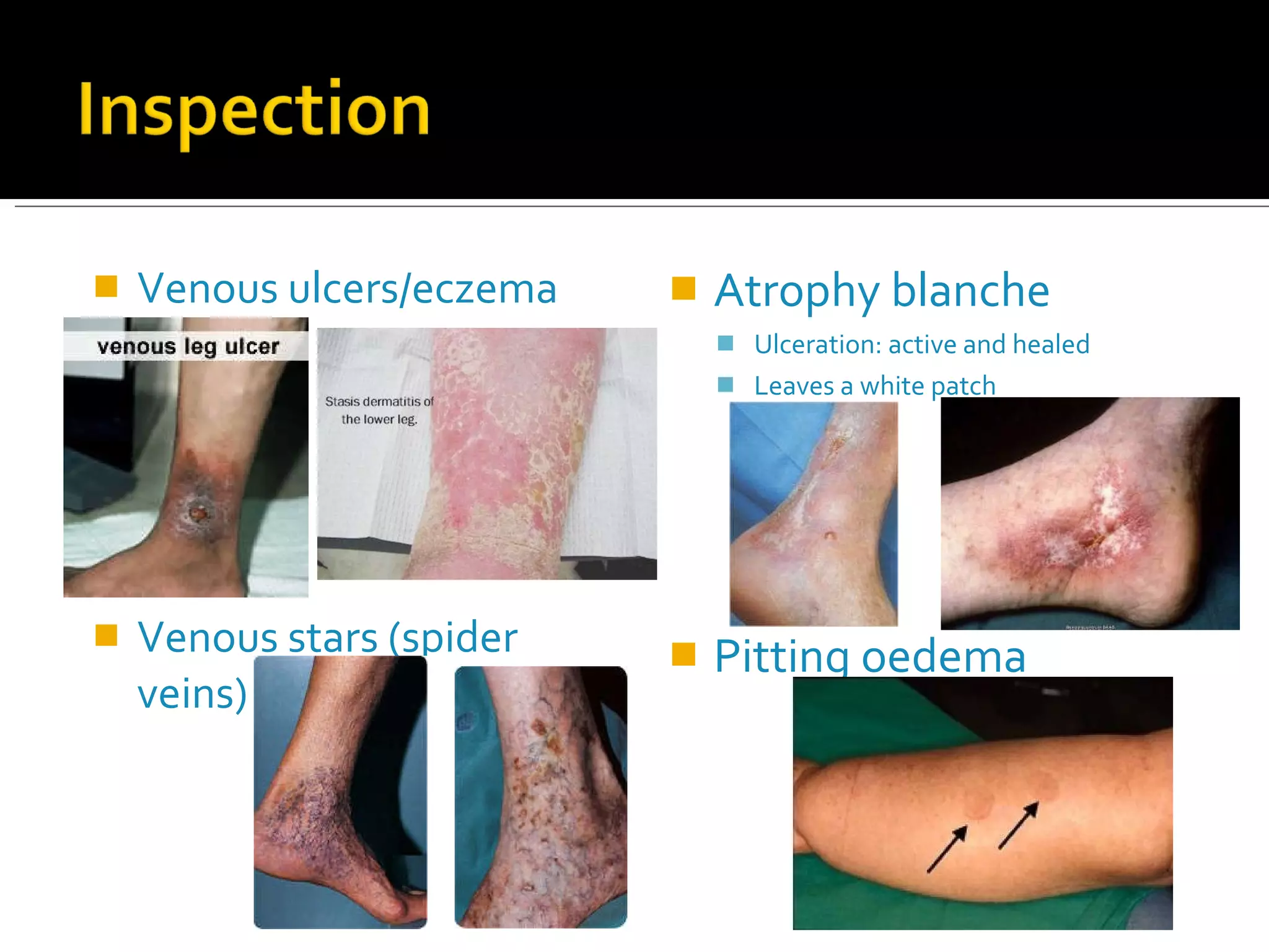 Varicose Veins | PPT