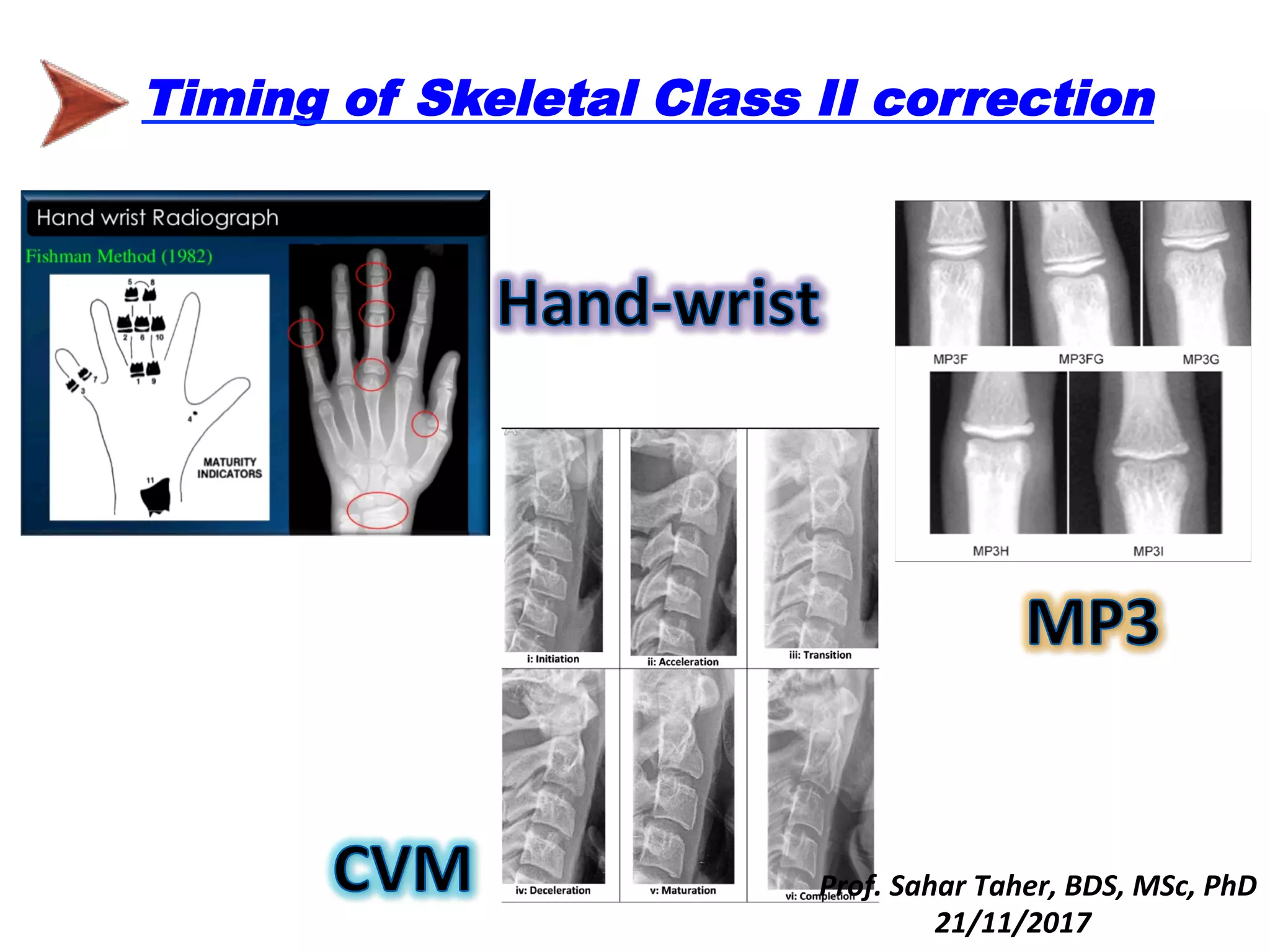 Skeletal Class II - Mixed Dentition, By Prof. Sahar Taher | PDF