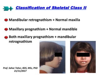 Skeletal Class II - Mixed Dentition, By Prof. Sahar Taher | PDF ...