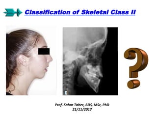 Skeletal Class II - Mixed Dentition, By Prof. Sahar Taher | PDF