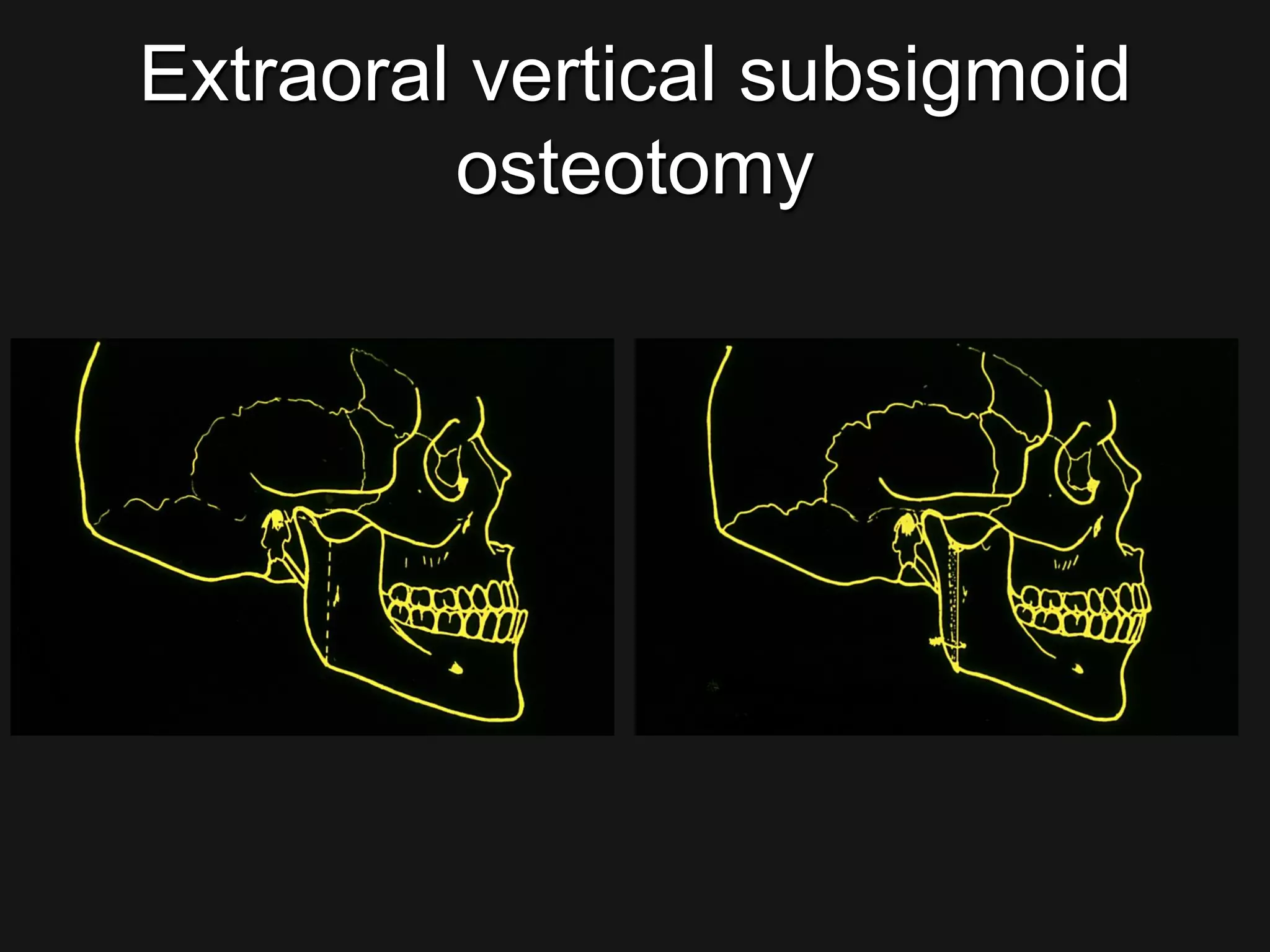 Skeletal deformities of lower third | PDF