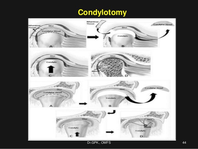 Skeletal deformities of lower third