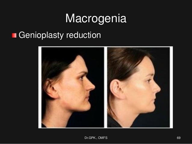 Skeletal deformities of lower third