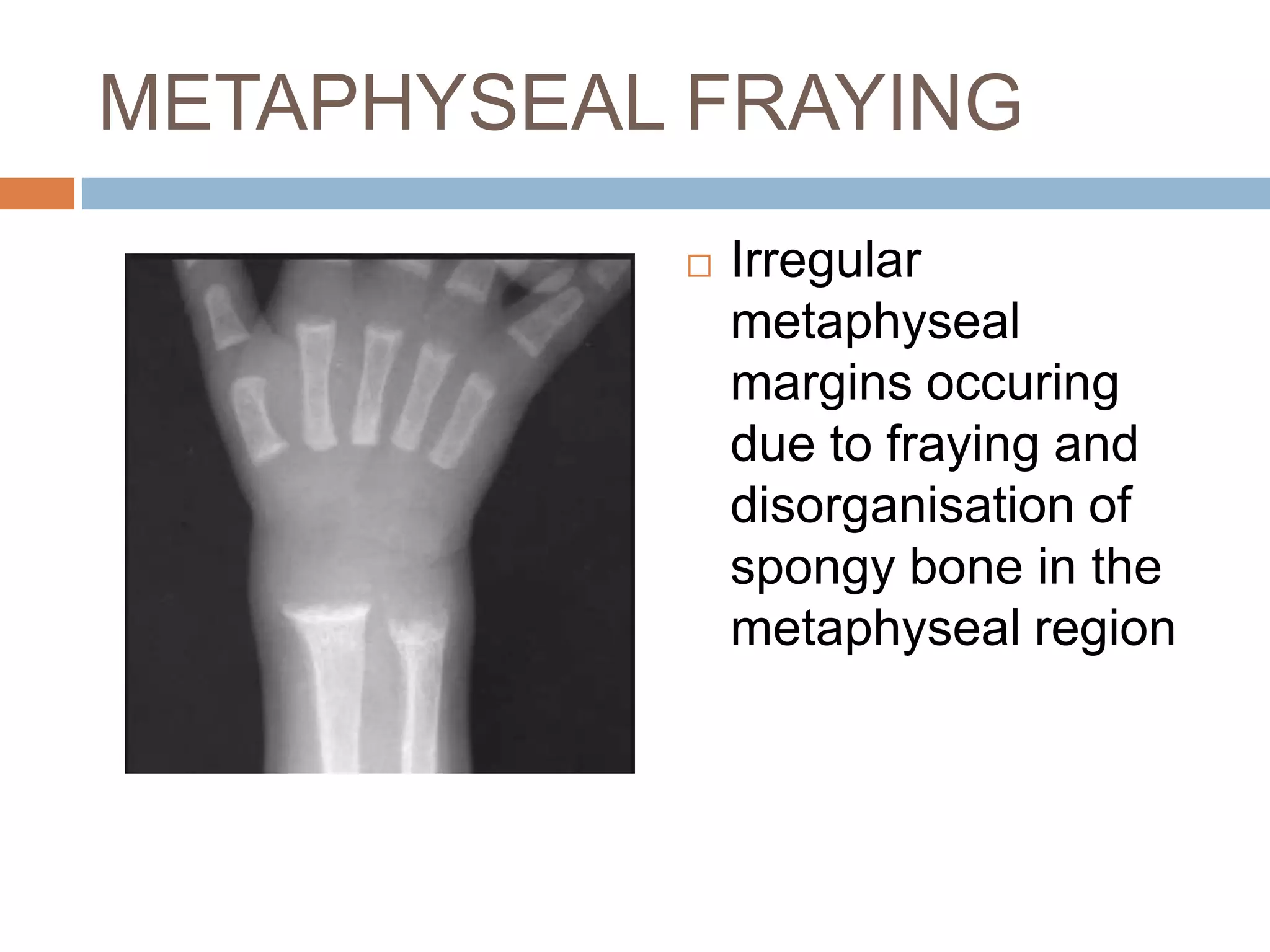 Skeletal disorders of metabolic origin | PPTX