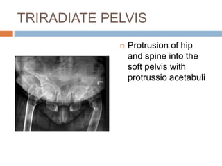 Triradiate Pelvis