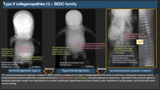 skeletal dysplasia-1.pptx presentation for students | PPT