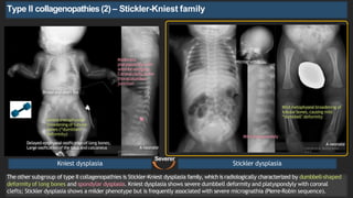skeletal dysplasia-1.pptx presentation for students | PPT