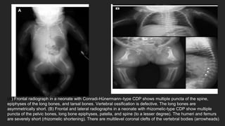skeletal dysplasia-1.pptx presentation for students | PPT