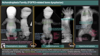 skeletal dysplasia-1.pptx presentation for students | PPTX