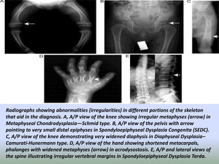 Skeletal dysplasia | PPTX