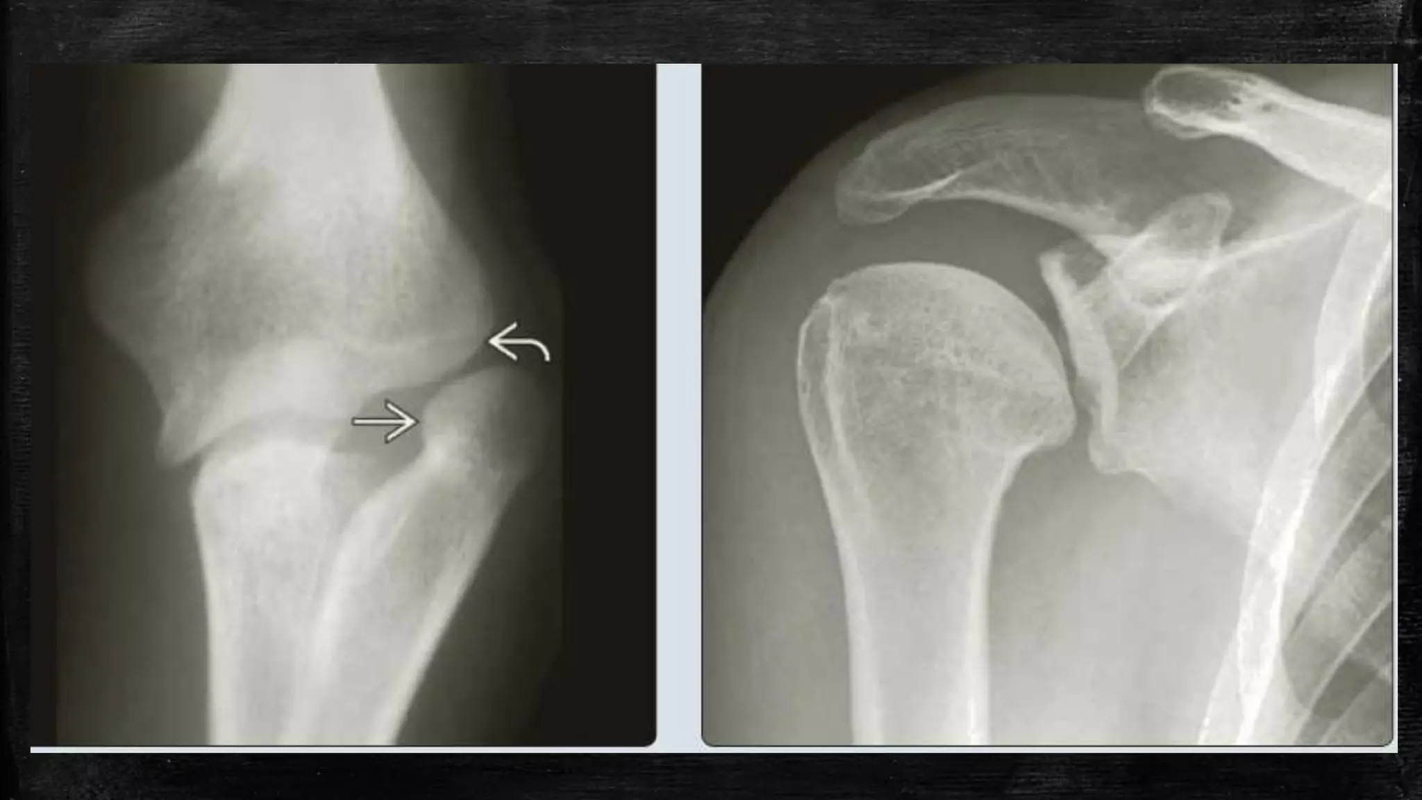 Skeletal dysplasia : Radiodiagnosis | PPTX