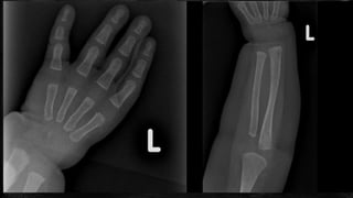 Skeletal dysplasia : Radiodiagnosis | PPTX